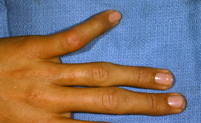 Clinodactyly - observation | Hand Surgery Resource